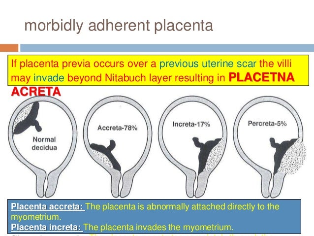 Aph Antepartum hemorrhage