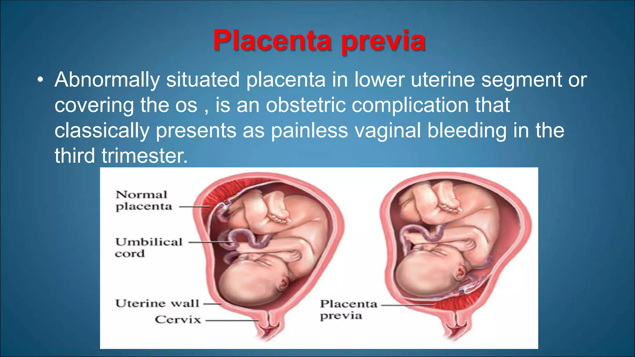 Antepartum Hemorrhage | PPTX