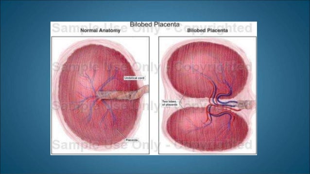 Antepartum Hemorrhage