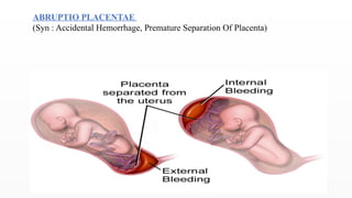 Antipartum hemorrhage and its types placenta previa & abruptio placenta ...