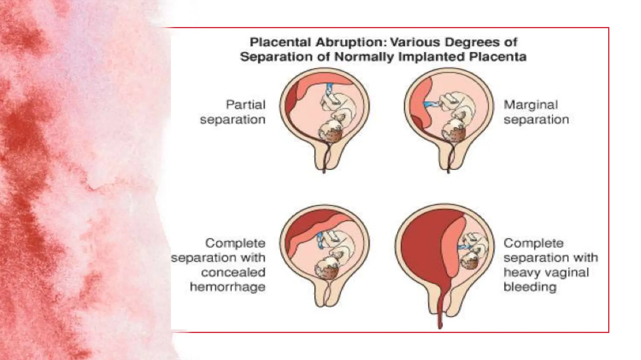 APH(Antepartum Hemorrhage)& PPH(Postpartum hemorrhage).pptx