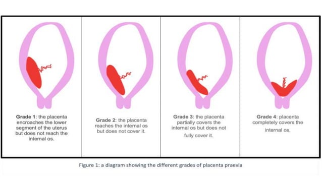 APH(Antepartum Hemorrhage)& PPH(Postpartum hemorrhage).pptx