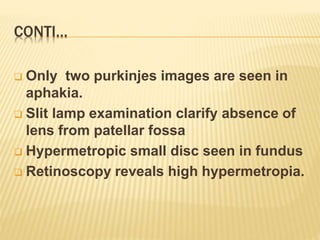 Aphakia | PPT