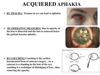 Aphakia | PPT | Free Download