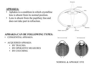 Aphakia | PPT