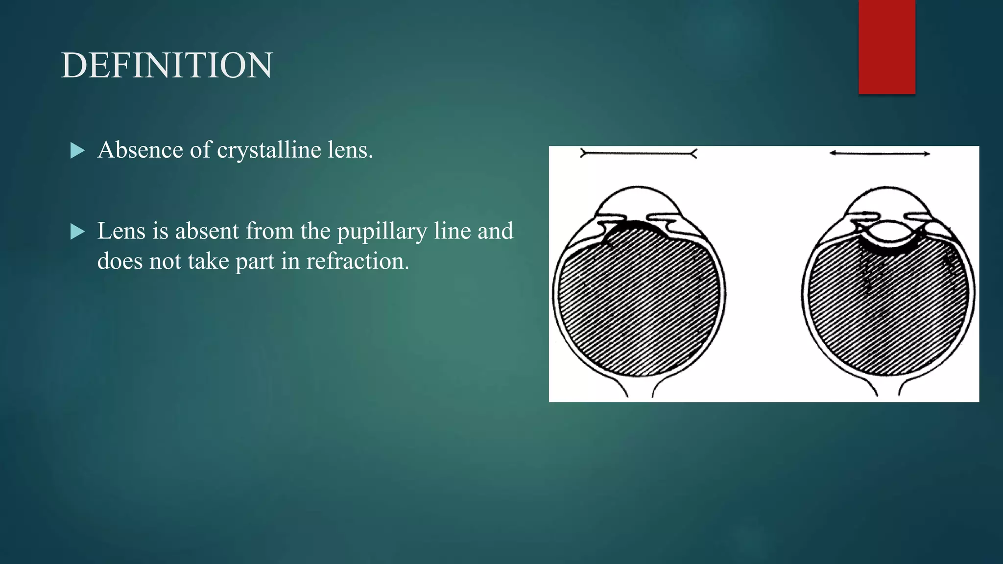 Aphakia and pseudophakia | PPTX