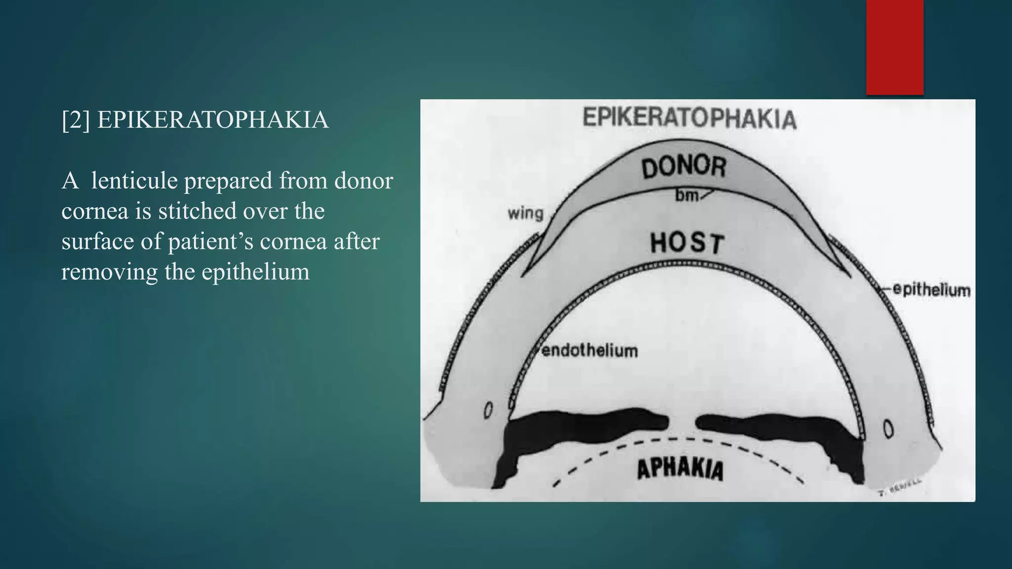 Aphakia and pseudophakia | PPTX