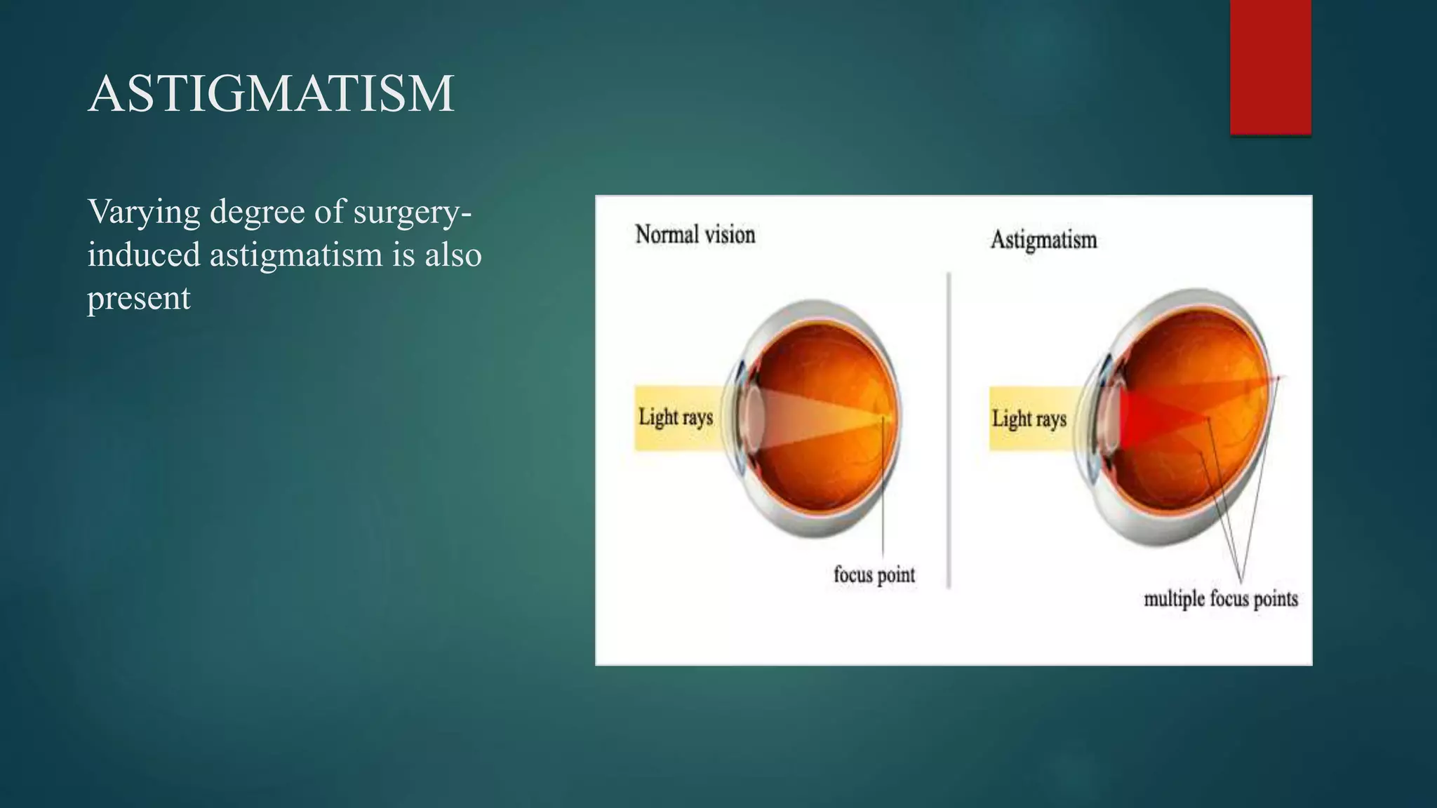 Aphakia and pseudophakia | PPTX