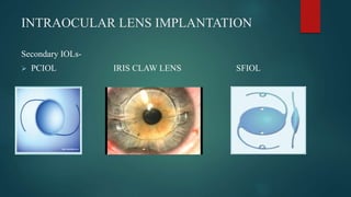 Aphakia and pseudophakia | PPTX | Eye and Vision Conditions | Diseases ...