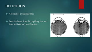 Aphakia and pseudophakia | PPTX