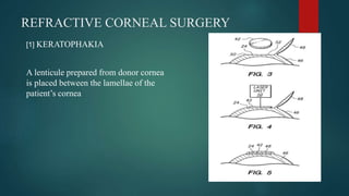 Aphakia and pseudophakia | PPTX