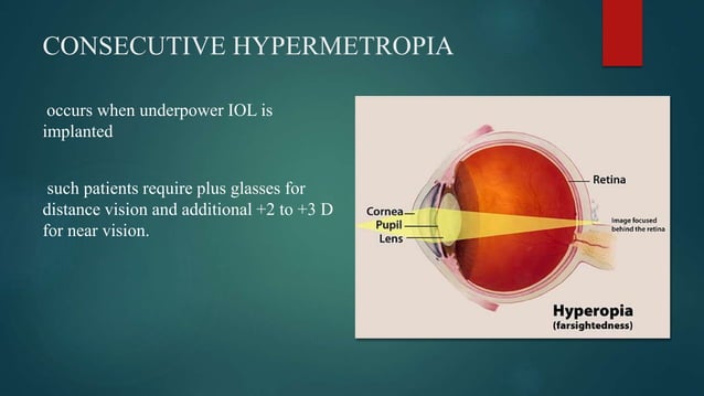 Aphakia and pseudophakia | PPTX | Eye and Vision Conditions | Diseases ...