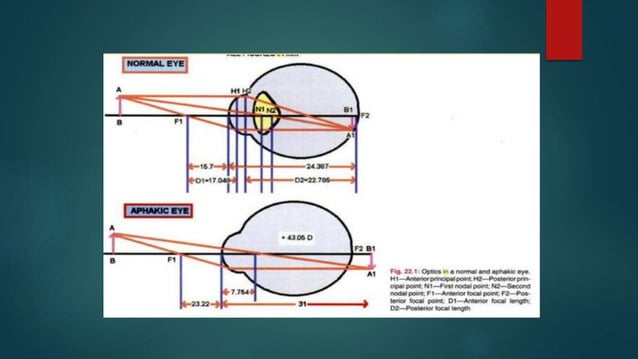 Aphakia and pseudophakia | PPTX | Eye and Vision Conditions | Diseases ...