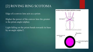 Aphakia and pseudophakia | PPT