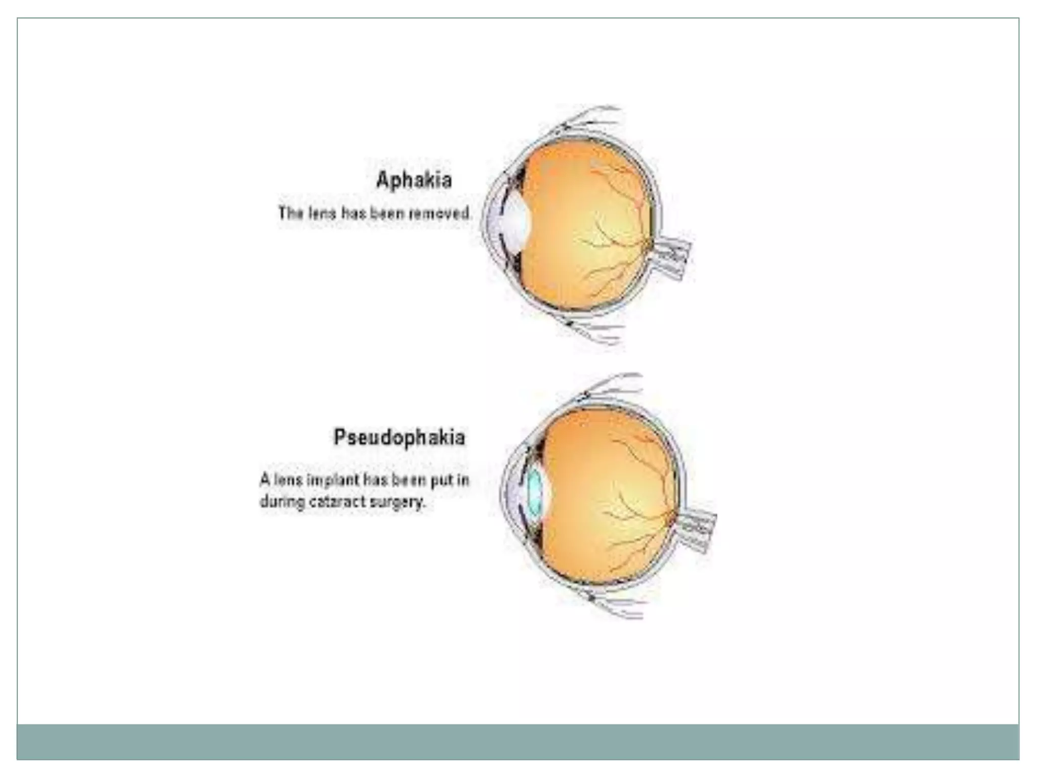 Aphakia and pseudophakia (1) | PPTX
