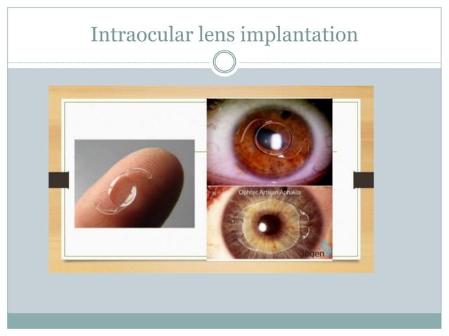 Aphakia and pseudophakia (1) | PPTX | Eye and Vision Conditions ...