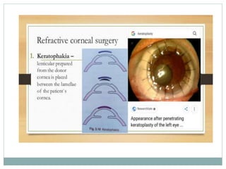 Aphakia and pseudophakia (1) | PPTX