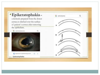 Aphakia and pseudophakia (1) | PPTX