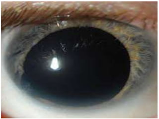 Aphakia and pseudophakia (1) | PPTX