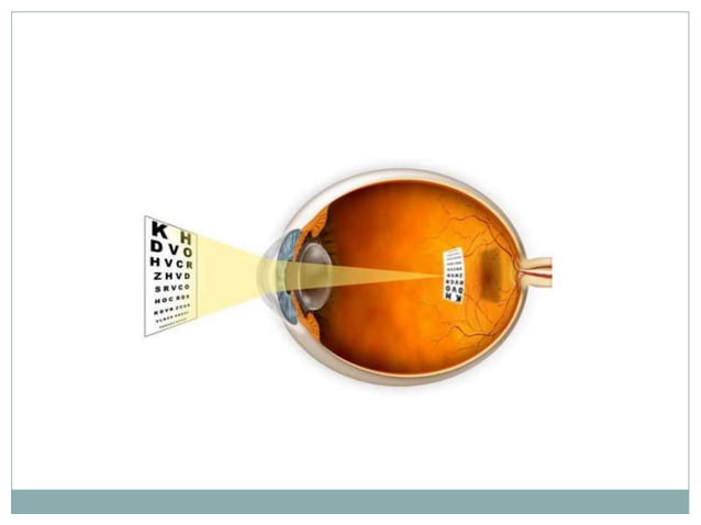 Aphakia and pseudophakia (1) | PPTX | Eye and Vision Conditions ...