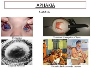 Aphakia and pseudophakia (1) | PPTX