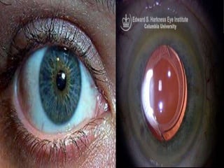 Aphakia or pseudophakia | PPTX | Eye and Vision Conditions | Diseases ...