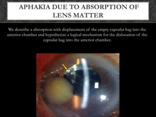 Aphakia or pseudophakia | PPT