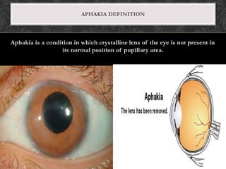 Aphakia or pseudophakia | PPT