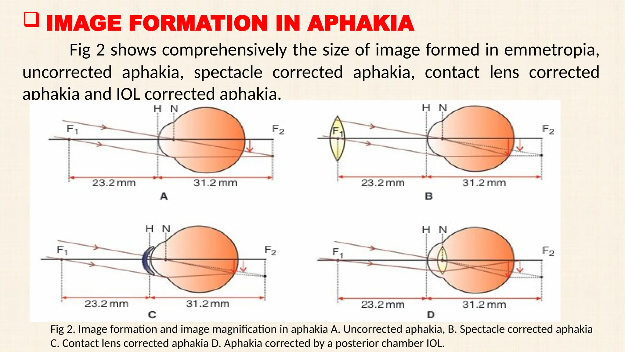 APHAKIA SLIDESHOW PRESENTATIONS PPT.pptx