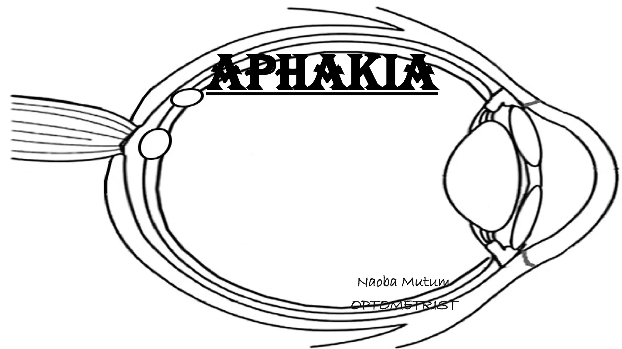 APHAKIA OF EYE PRESENTATION. slideshare. net | PPTX
