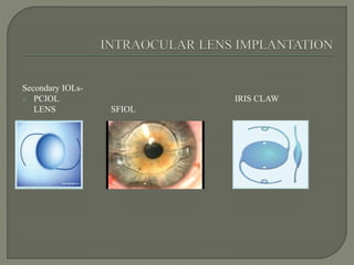 Aphakia & Pseudophakia.pptx