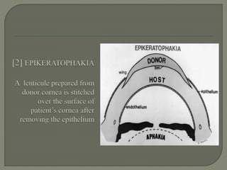 Aphakia & Pseudophakia.pptx