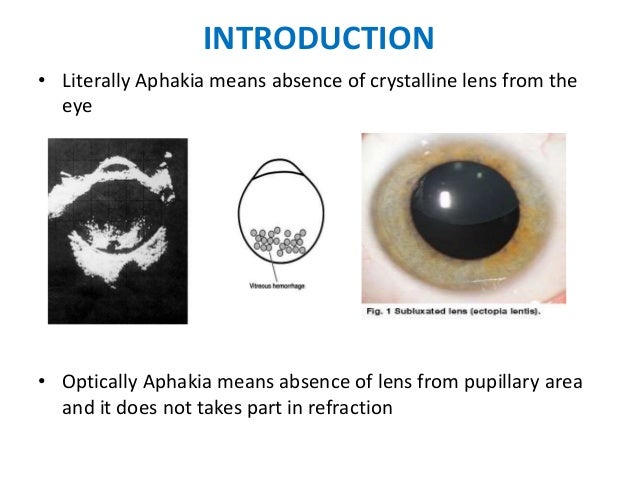 Aphakia by SURAJ CHHETRI