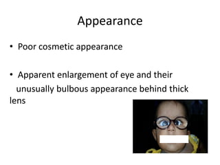 Aphakic spectacle dispensing | PDF