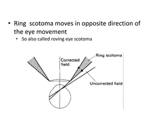Aphakic spectacle dispensing | PPT
