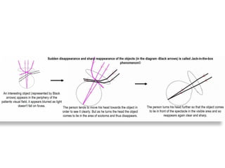 Aphakic spectacle dispensing | PPT