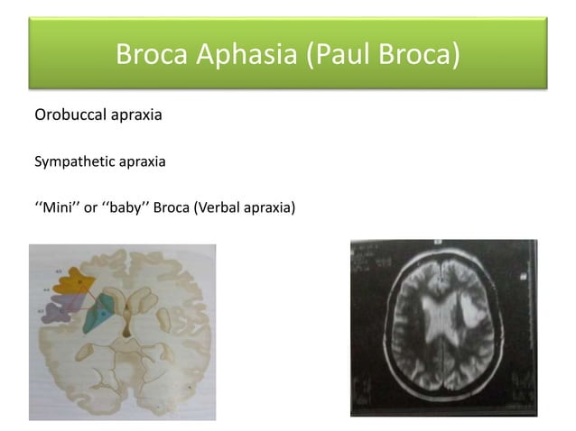 APHASIA and APHASIC SYNDROMES PRESENTATION NEUROLOGY | PPTX | Brain and ...