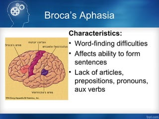 Broca's aphasia- neurolinguistics- kiran nazir | PPT