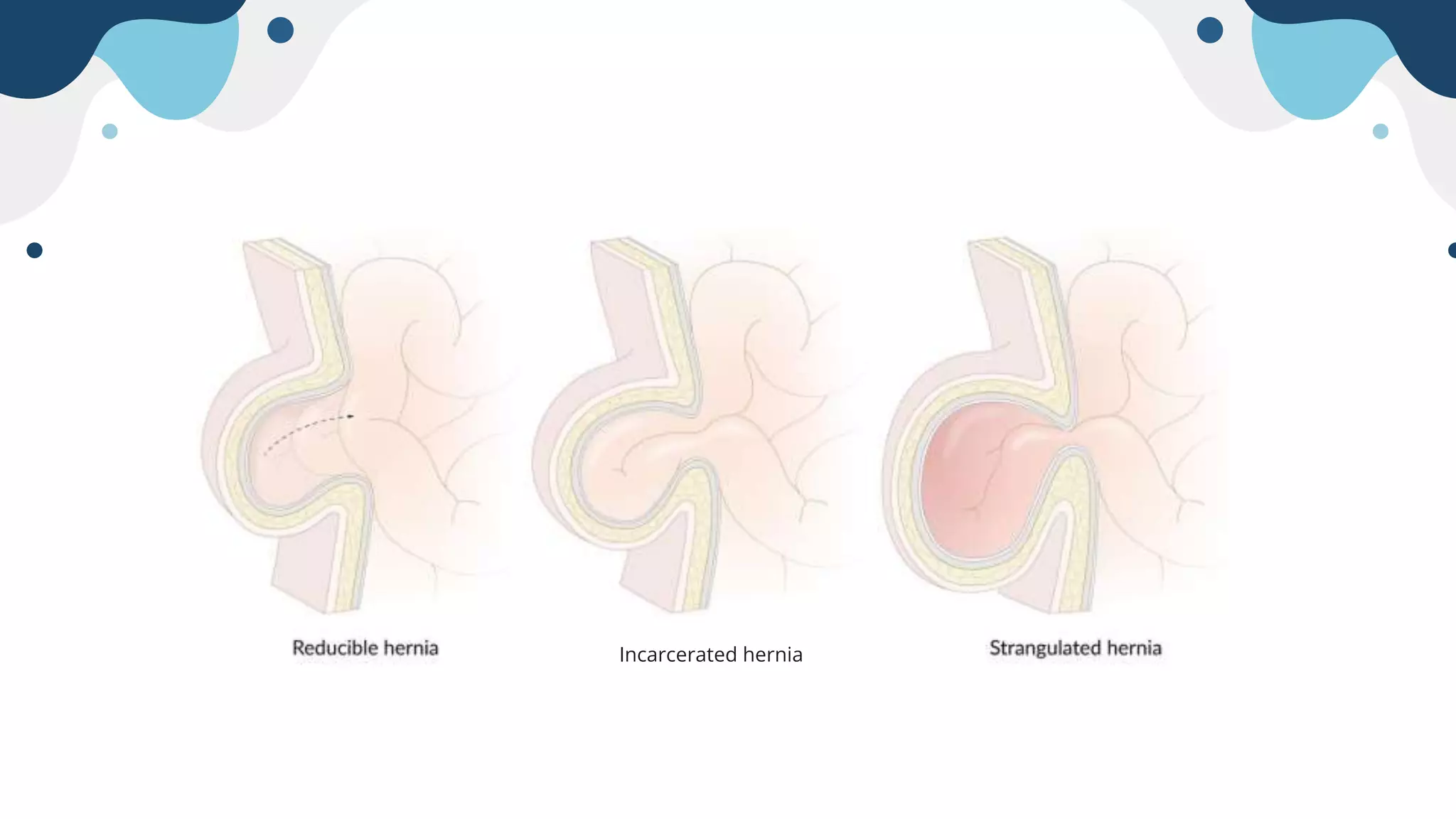 Appendicitis and Hernia.pptx