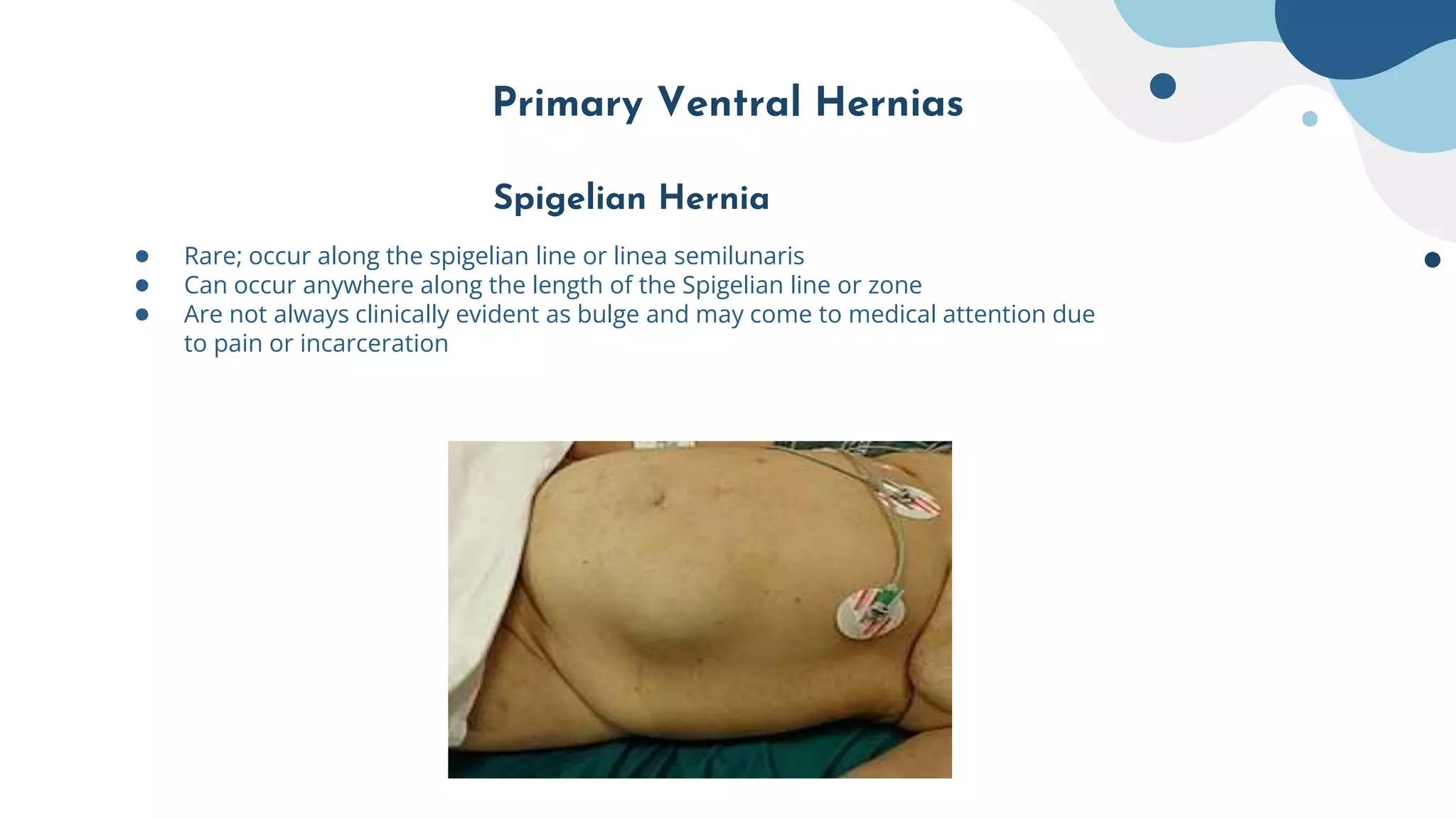 Appendicitis and Hernia.pptx