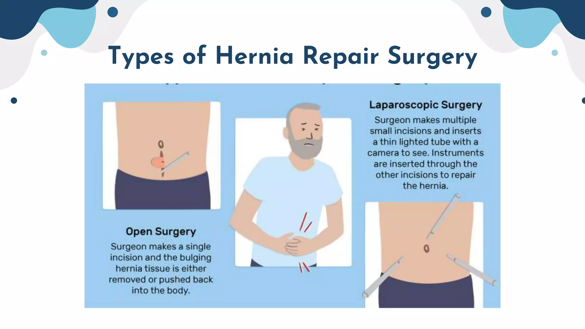 Appendicitis and Hernia.pptx