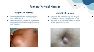 Appendicitis and Hernia.pptx