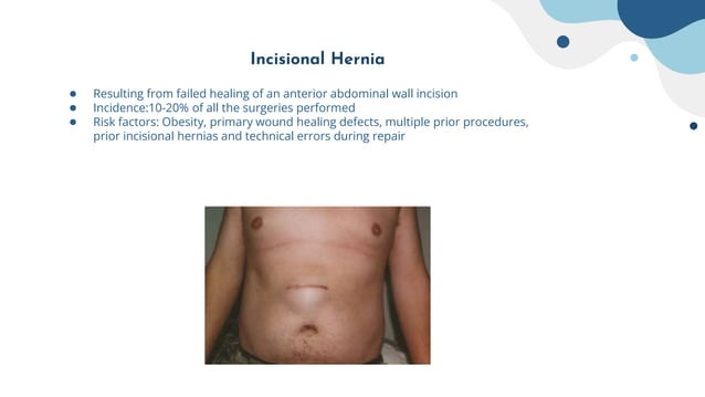 Appendicitis and Hernia.pptx