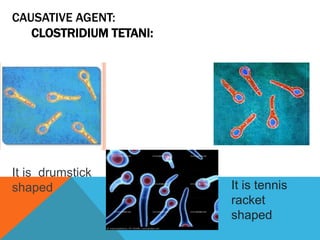 TETANUS AND TRACHOMA | PPTX