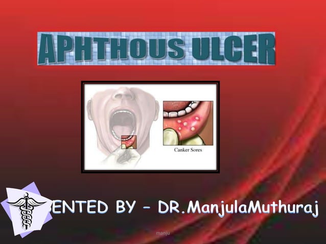 Aphthous Ulcer | PPTX
