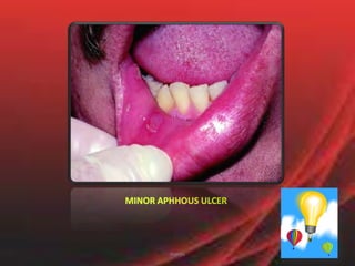 Aphthous Ulcer | PPTX