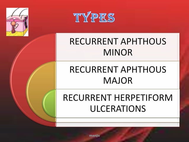 Aphthous Ulcer | PPTX
