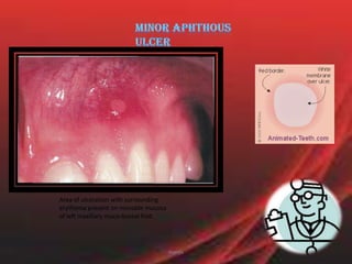 Aphthous Ulcer | PPTX