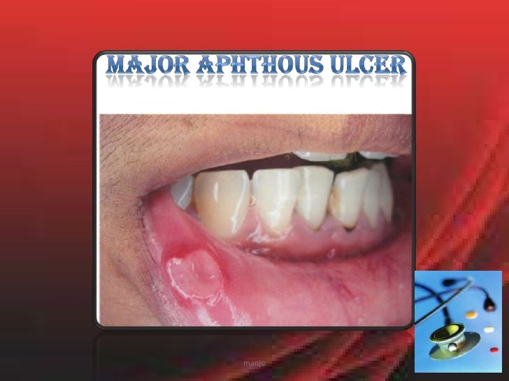 Aphthous Ulcer