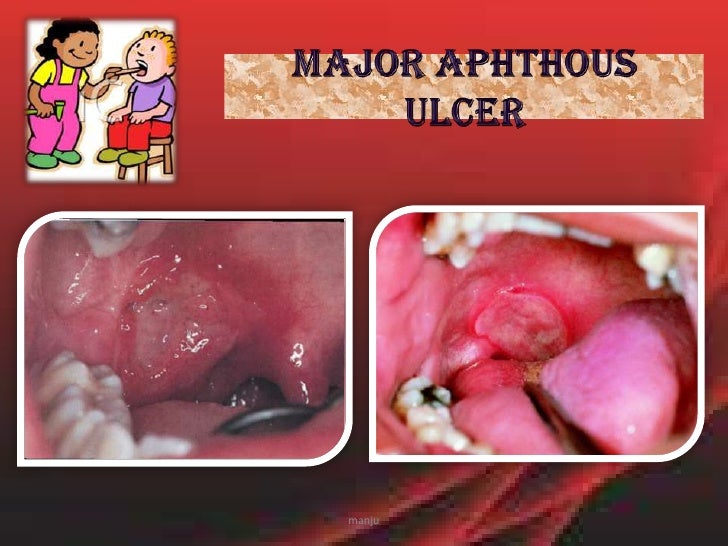 Aphthous Ulcer Aphthousstomatitis Cankersore Ulcer Aphthous Ulcers